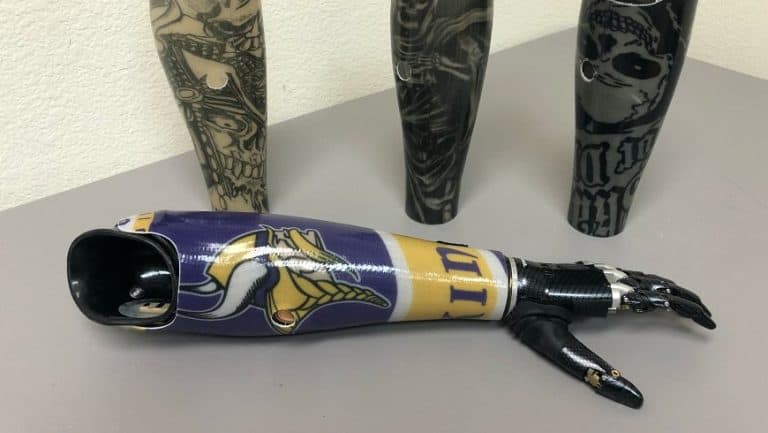 Below Elbow Prosthetics | Evolve Prosthetics & Orthotics