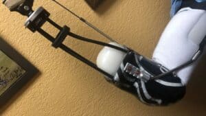 Above The Elbow Prosthetic Arms In Las Vegas & Henderson | Evolve ...