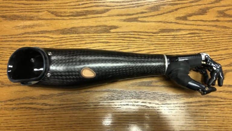 Bionic Limbs Vs. Traditional Prosthetics: Which Is Right For You ...