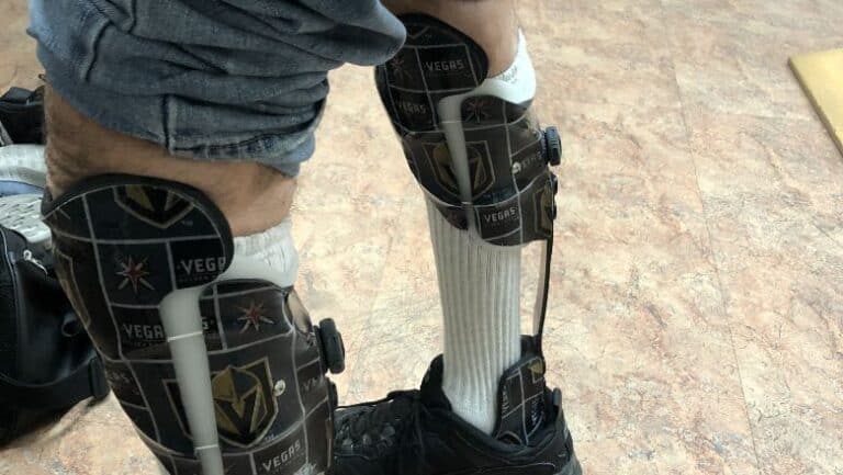 Customizing Your Carbon Fiber Braces | Evolve Prosthetics & Orthotics