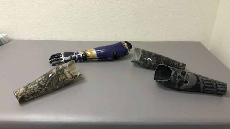 How To Care For Your Prosthetic Device | Evolve Prosthetics & Orthotics