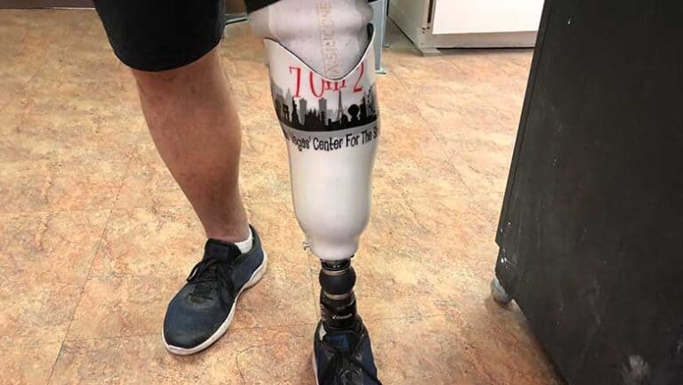 Managing Phantom Limb Pain | Evolve Prosthetics & Orthotics